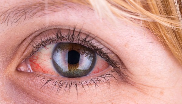 Por que os olhos ficam vermelhos na piscina? 5 remédios naturais para ...