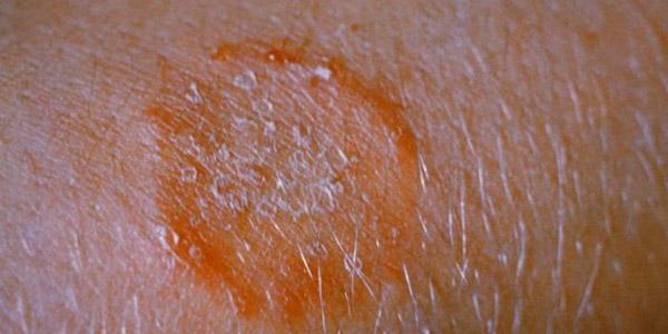 Impingem - Veja o que é e Os Tratamentos caseiros Mais Eficazes - greenMe