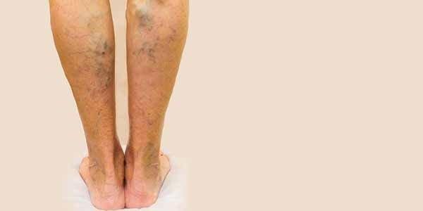 Varizes: causas, sintomas e tratamentos - greenMe